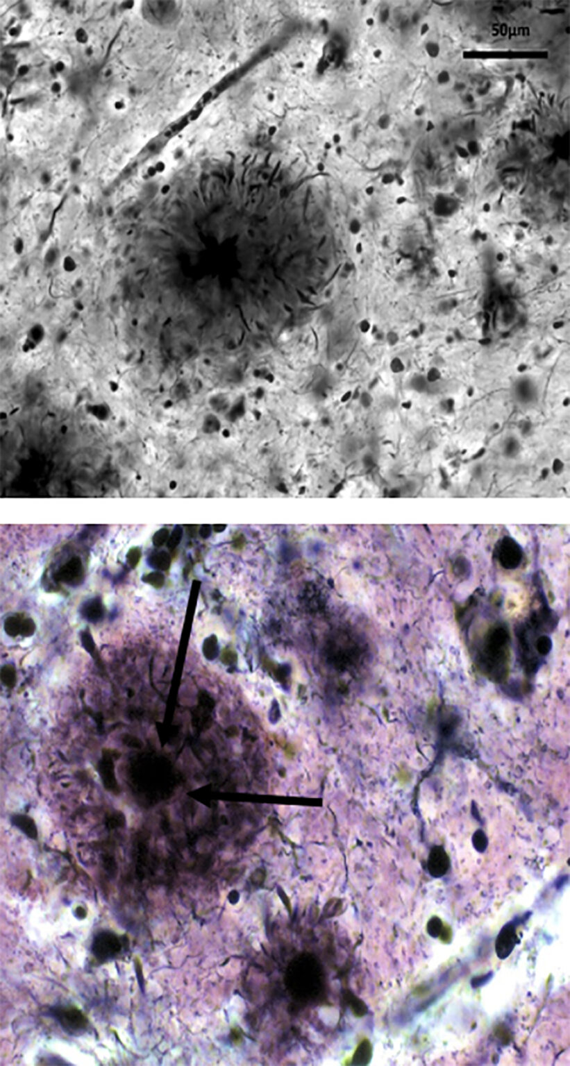 Terapia en la enfermedad de Alzheimer y la aprobación de Lecanemab ...